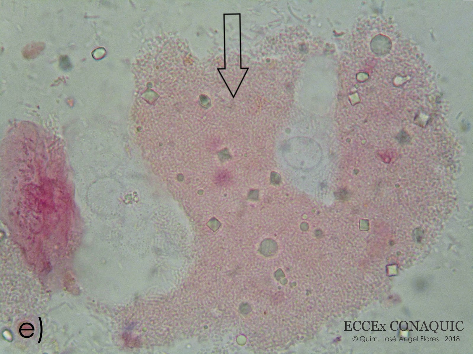 Caso UR-abril-18 (Enfoque: bacteriuria)