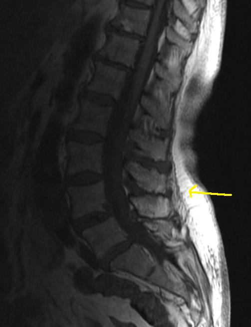 Lumbar Interspinous Bursitis (Baastrup Disease) - Sumer's Radiology Blog