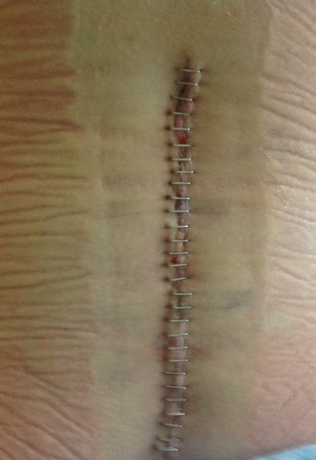 Staples Surgery Stitches at Harrison Fitch blog