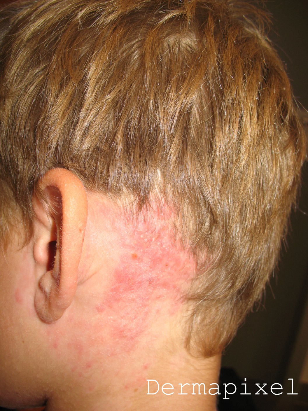 Dermapixel: septiembre 2012