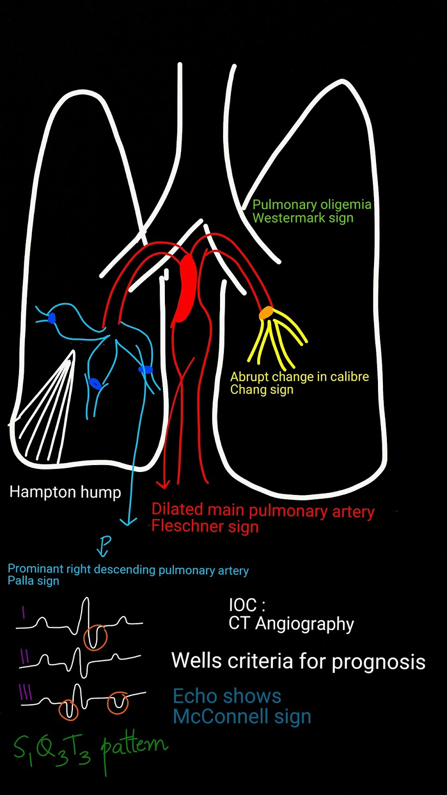 Medicowesome: Pulmonary Embolism Picmonic