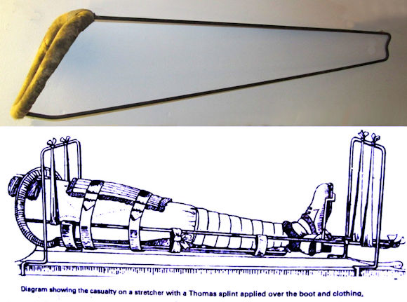 Thomas Splint And Pearson Attachment