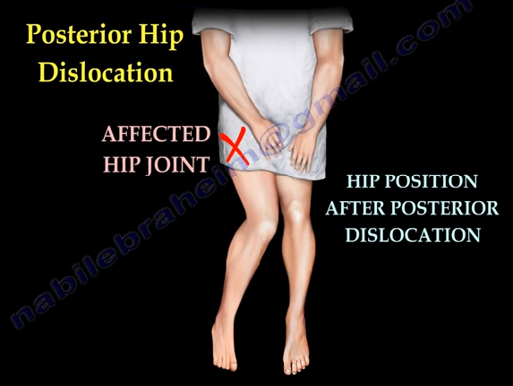 Nursing Care Plan Posterior Hip Dislocation Left Images