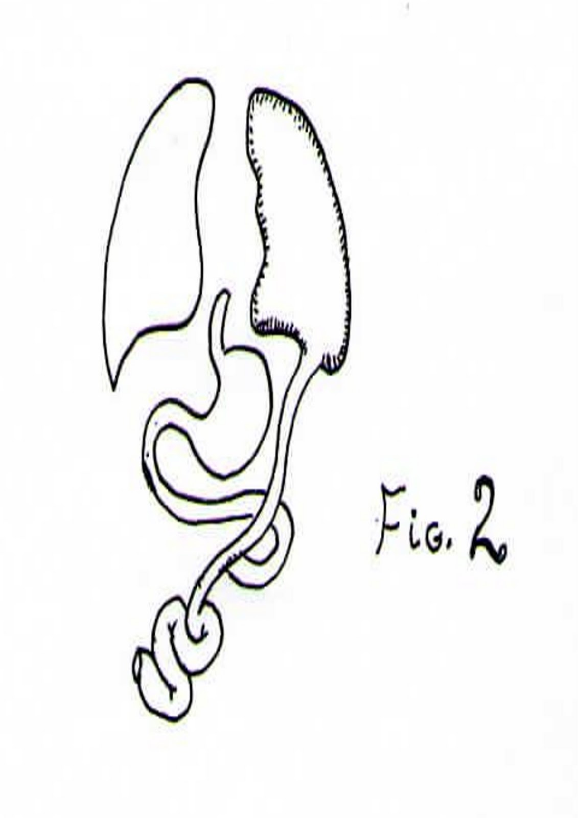 Tratamento Cirurgico Heterodoxo de Empiêma Pleural Pós Pneumonectomia ...