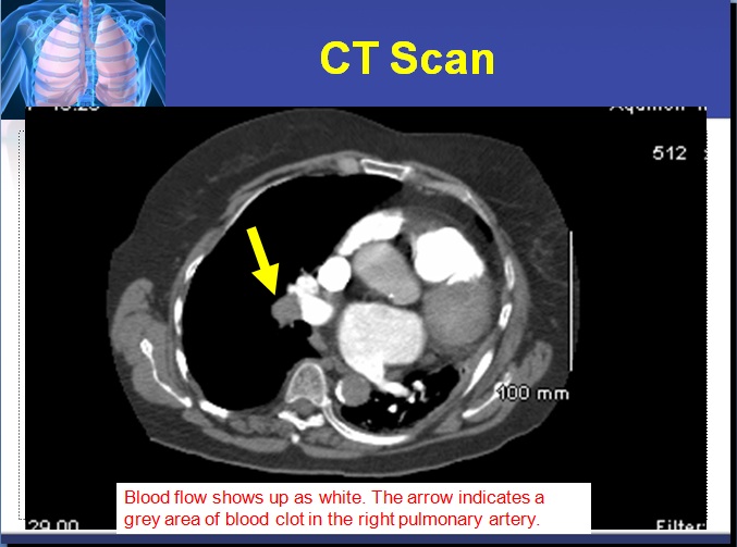 Kier Does Life: How Does a Professional Athlete Get a Pulmonary Embolism???
