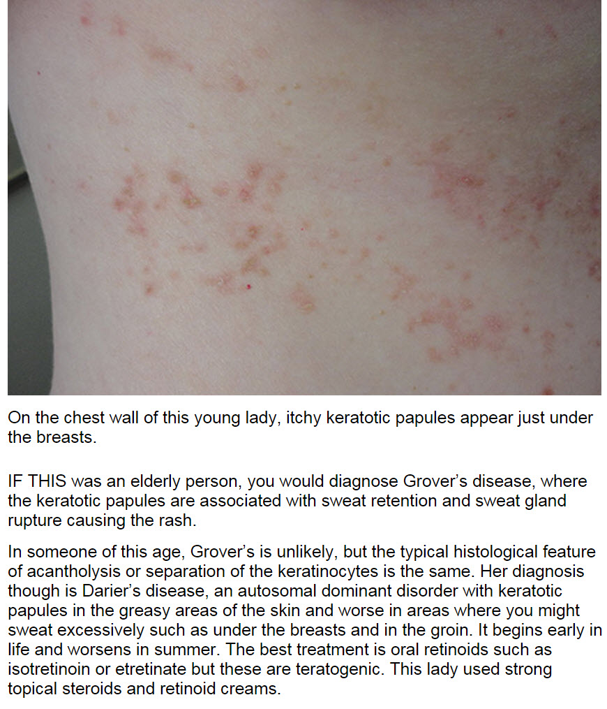 Consultations in Dermatology: Darier's Disease