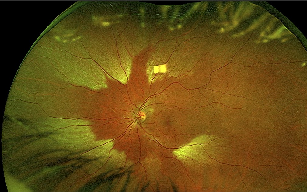 Sonoran Desert Eye Center: MYELINATED NERVE FIBERS