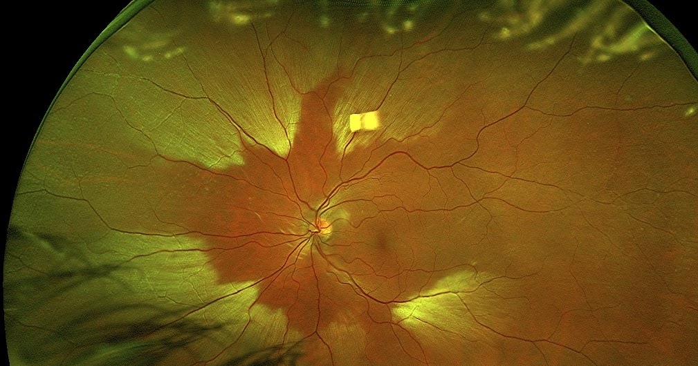 Sonoran Desert Eye Center: MYELINATED NERVE FIBERS