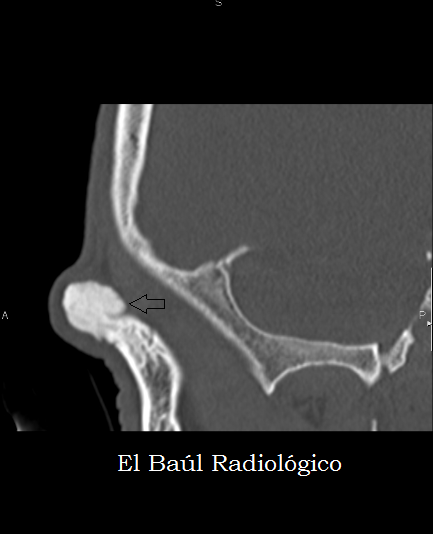 El Baúl Radiológico: OSTEOMAS CRANEALES. (Cranial Osteomas. CT Findings ...