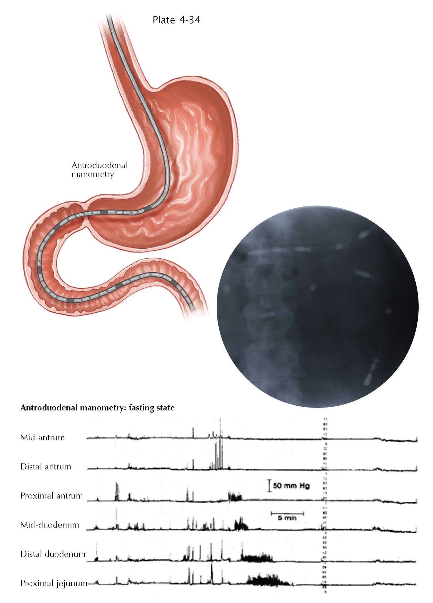DIAGNOSTIC AIDS IN GASTRIC DISORDERS: ANTRODUODENAL MANOMETRY ...