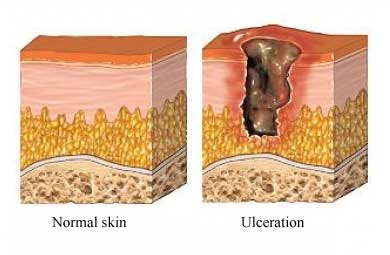 Get Well With singel Remedy: SKIN ULCERS