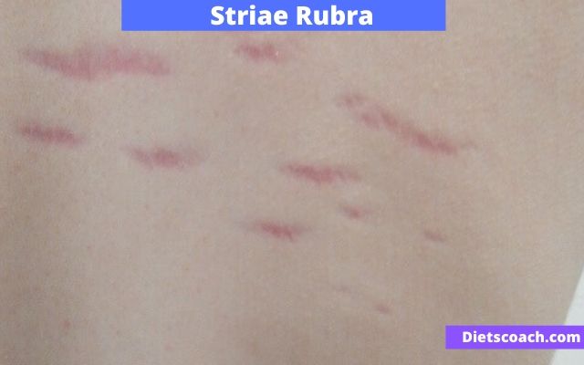 Types of Stretch Marks (With Pictures) | Striae classification
