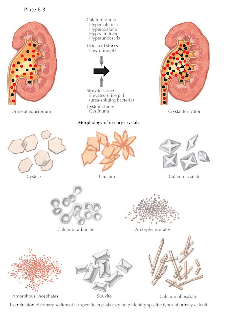 UROLITHIASIS - pediagenosis