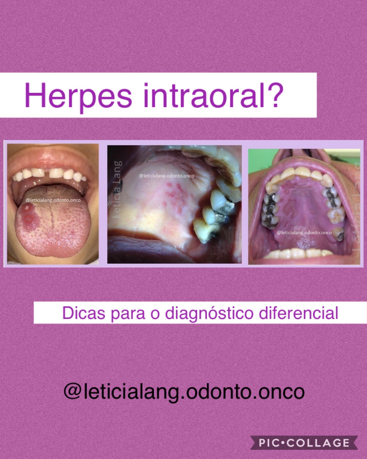 Letícia Lang Odonto-oncologia: Herpes intraoral?