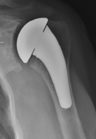 Shoulder Arthritis / Rotator Cuff Tears / Shoulder Pain : Shoulder ...