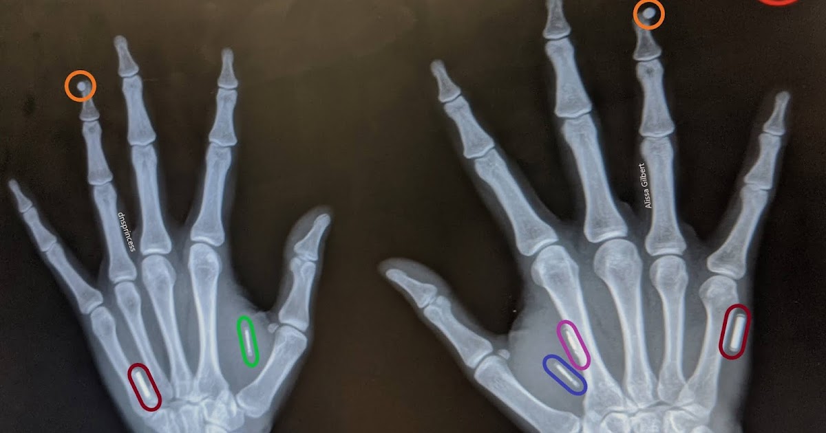 My biohacking implants (July 2020) with referrals and links