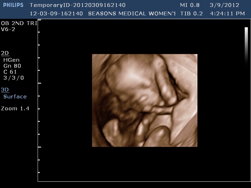 And this is my Joy: 17 weeks and an early ultrasound...