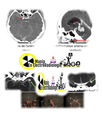 ANGIOSCANNER CEREBRALE