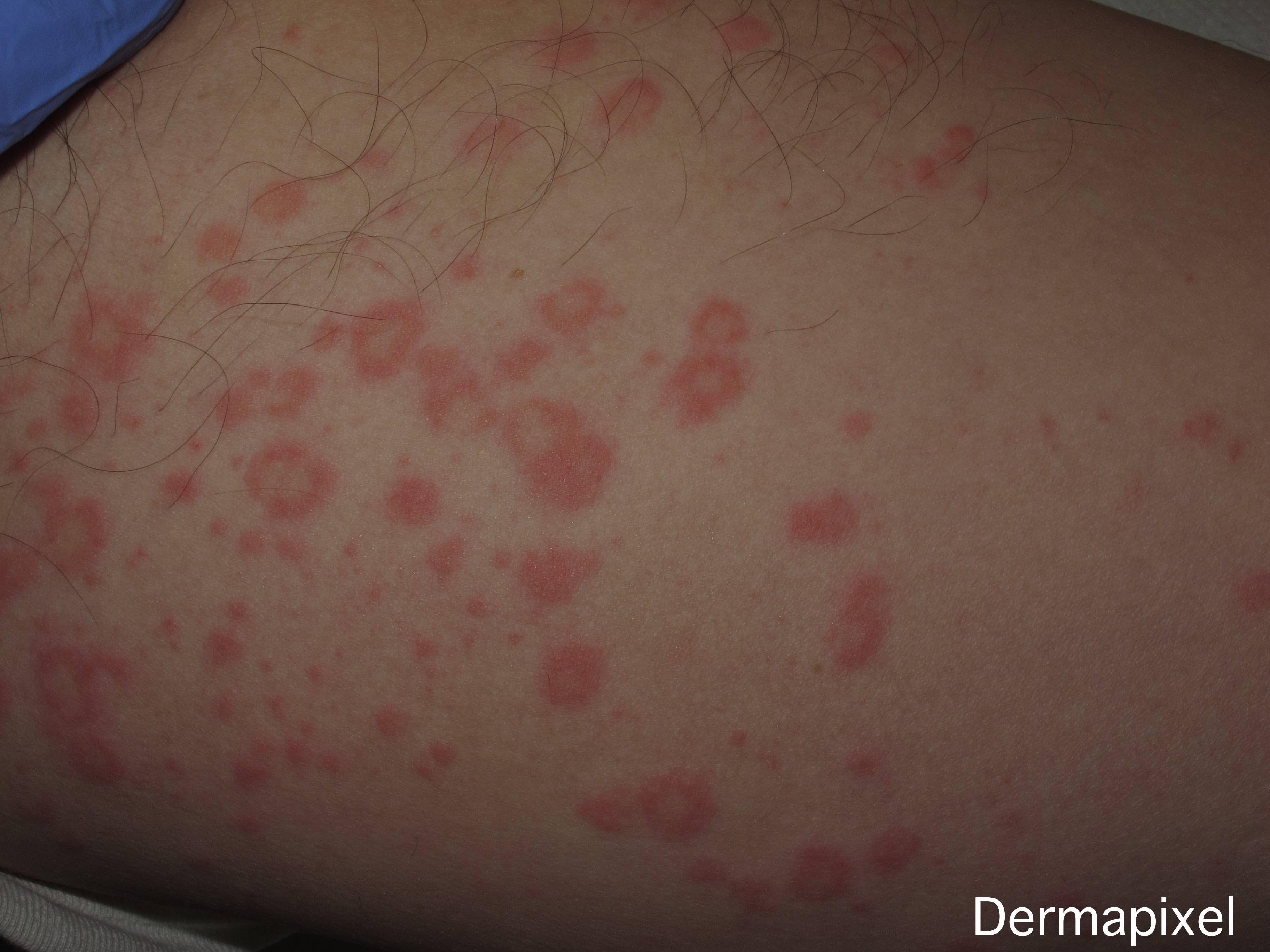 Dermapixel: Ronchas que pican