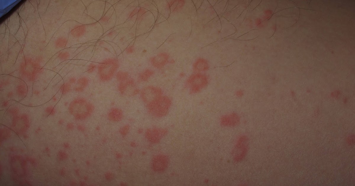 Dermapixel: Ronchas que pican