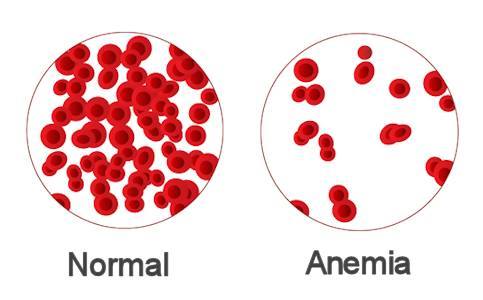Anemia causes and detection methods