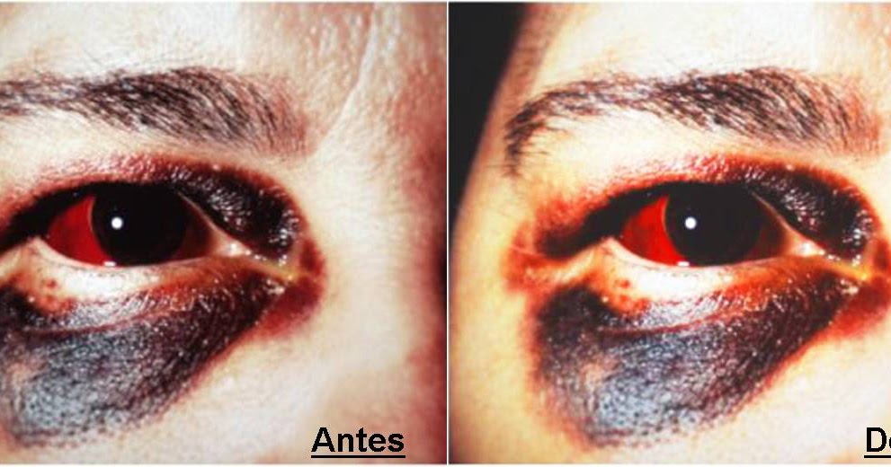 Trauma Ocular: Tipo de Lesiones Visuales