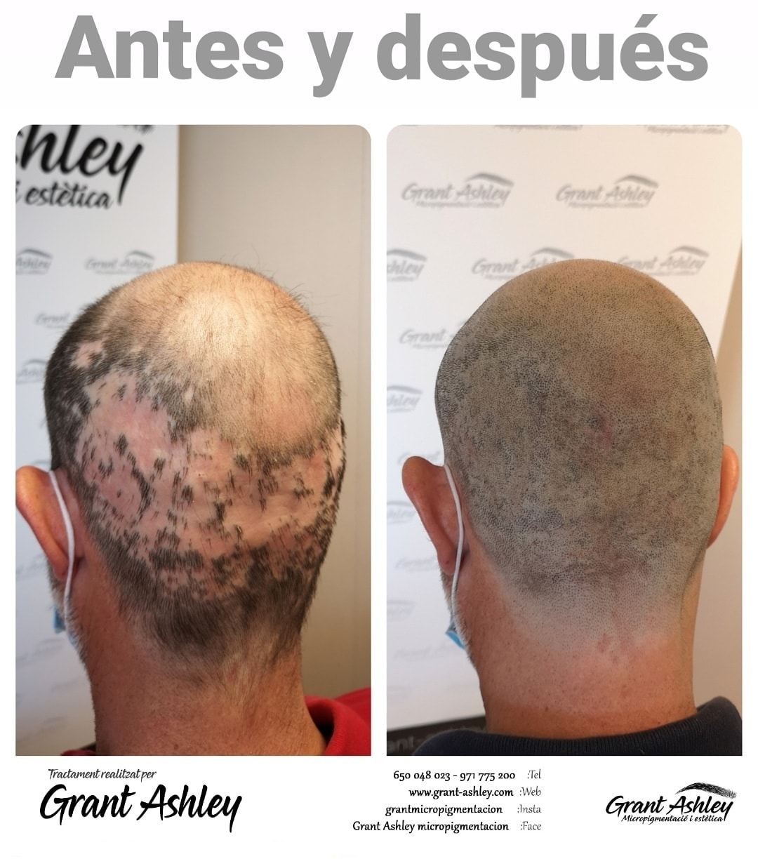 Micropigmentacion capilar mallorca - Grant Ashley | Grant Ashley ...