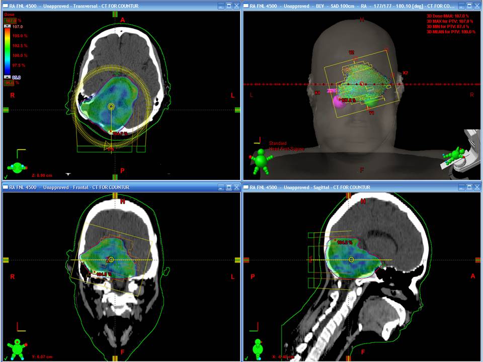 Cafe Radiologi: Peran Radioterapi Didalam Pengobatan Kanker Astrocytoma