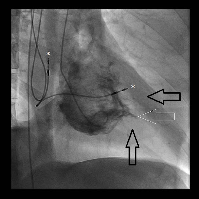 Spade shaped Left Ventricle in Apical variant of Hypertrophic ...