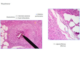 HISTOLOGIA90: TIPOS DE NECROSE