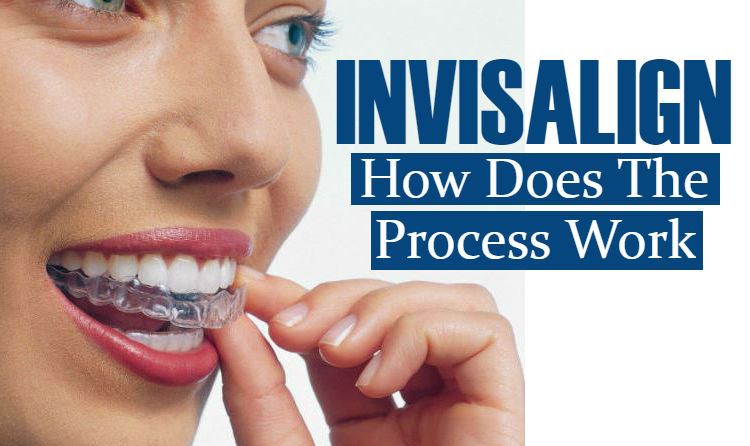 Chino Aesthetic Dental: How Does The Process of Invisalign Work?