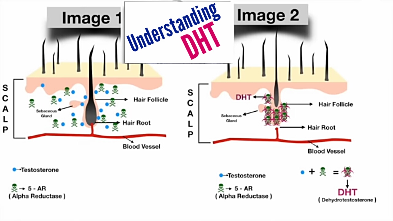 Natural solutions 2.0: WHAT IS DHT 🤔? HOW TO REGROW HAIR BY BLOCKING ...