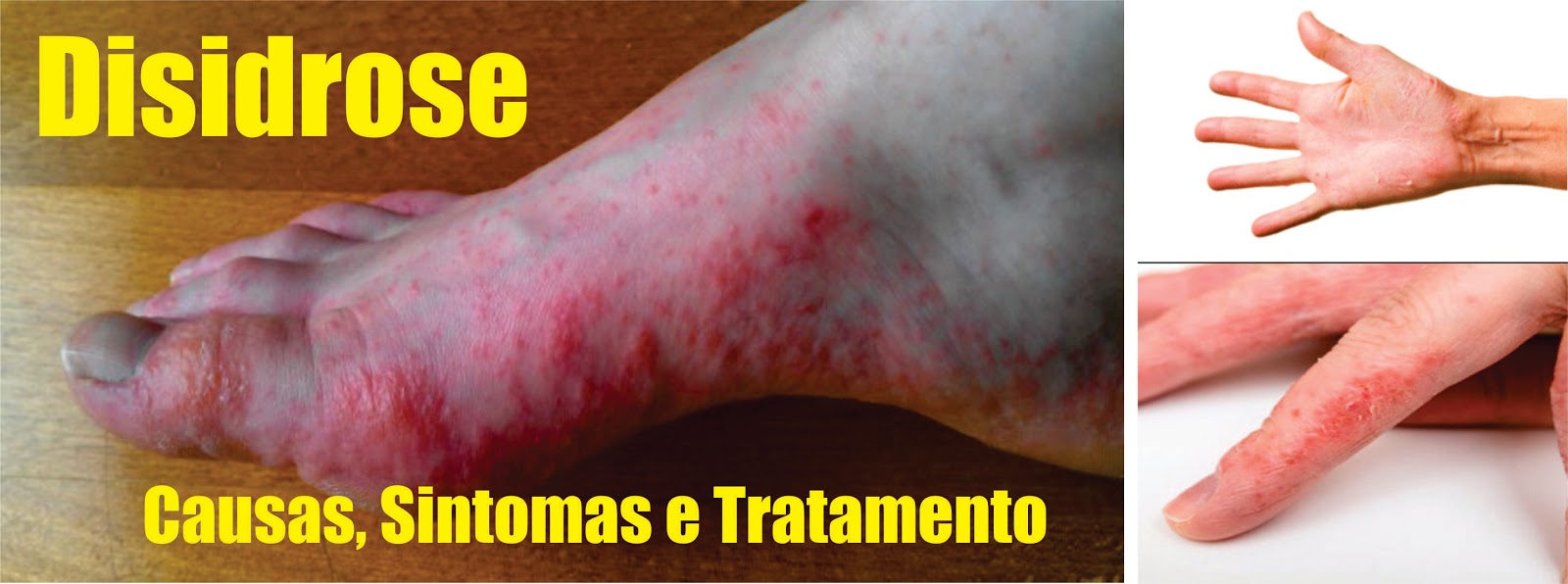 Disidrose no Pé - Causas, Sintomas e Tratamentos - Como Cuidar dos Pés