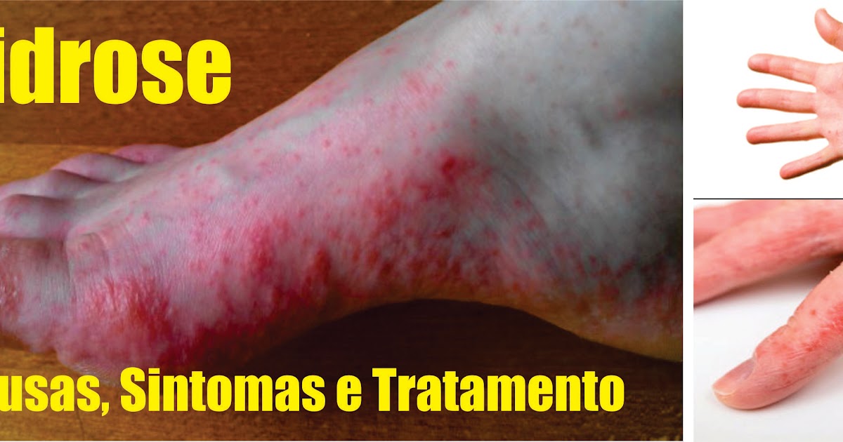 Disidrose no Pé - Causas, Sintomas e Tratamentos - Como Cuidar dos Pés