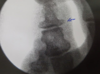 HELOMA INTERDIGITAL EN FALANGE DISTAL