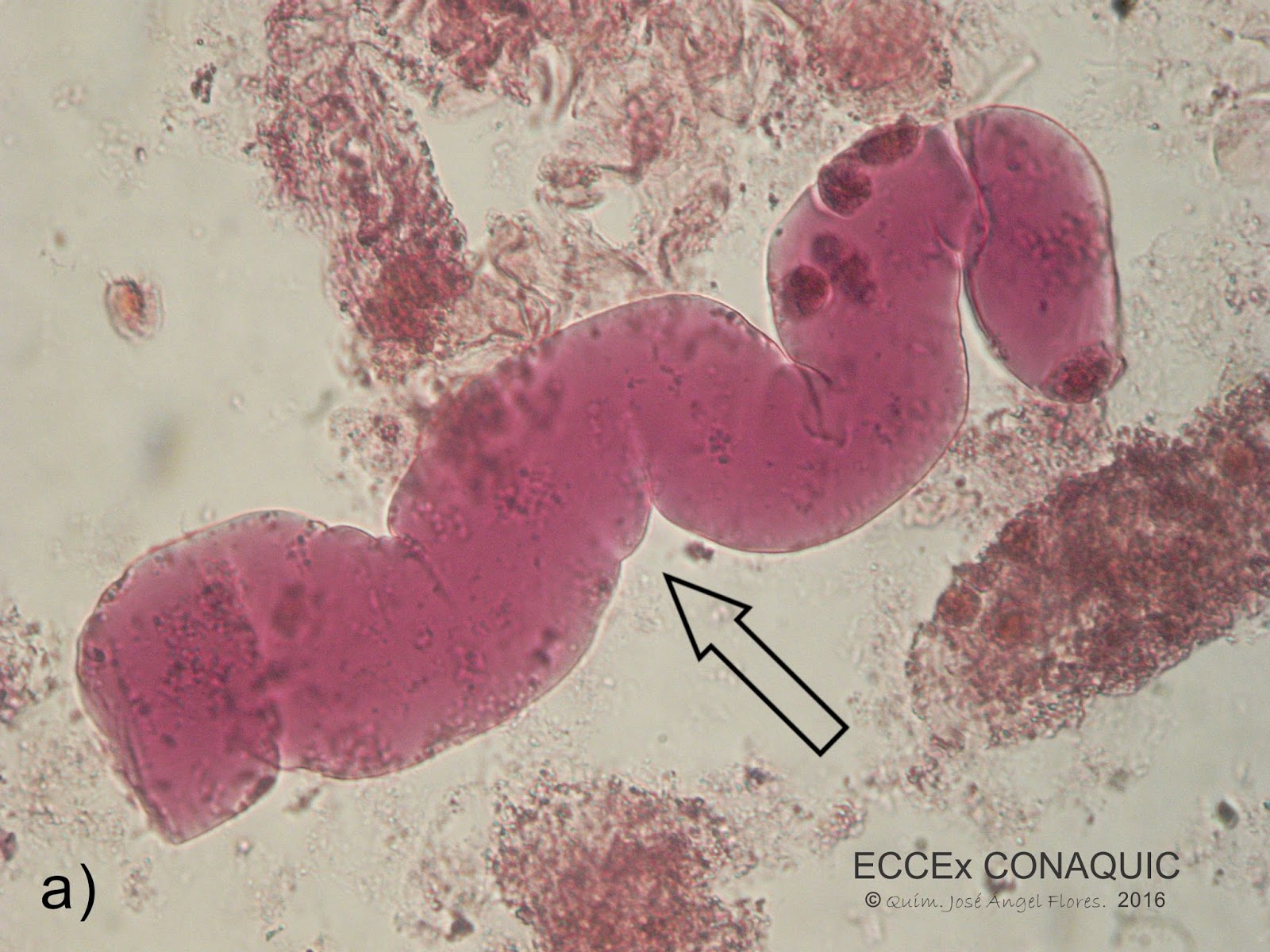 Caso UR-marzo-16 (Enfoque: cilindruria)