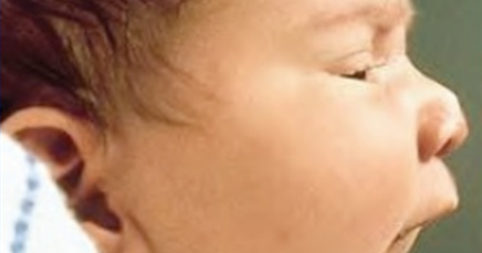 Pierre robin sequence adults - Derdental