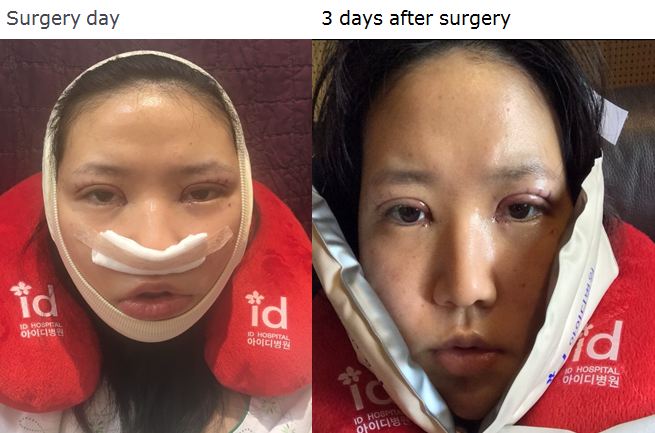 ID Hospital Korea: Japanese girl making her dream come true by plastic ...