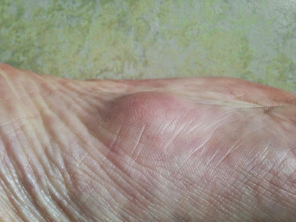 Ledderhose Disease Blog: Interview: Ledderhose surgery patient from Ohio