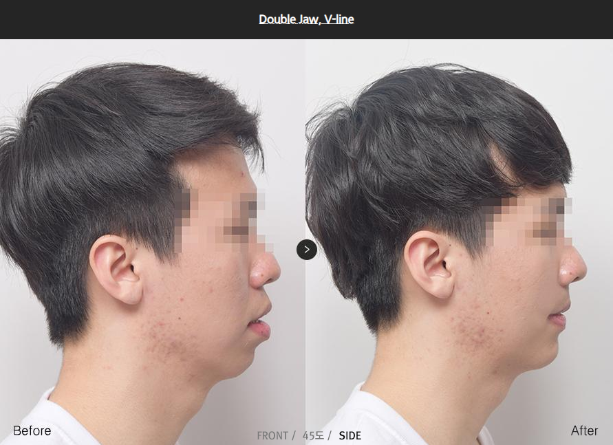 Want to achieve ideal face shape (Protruded mouth, jaw correction ...