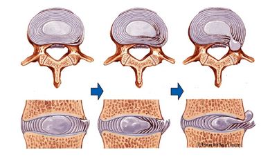 Dr. Jorge Cabrera: El disco intervertebral