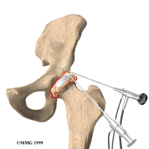 An Overview of Hip Arthroscopy Surgery | World Wide Web