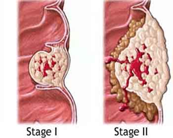 10,000 Strong Against Thyroid Cancer: Thyroid Cancer 2011 Review