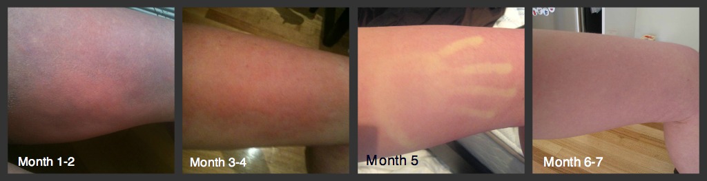 Topical Steroid Withdrawal Journey-Healing Eczema and Red Skin Syndrome ...
