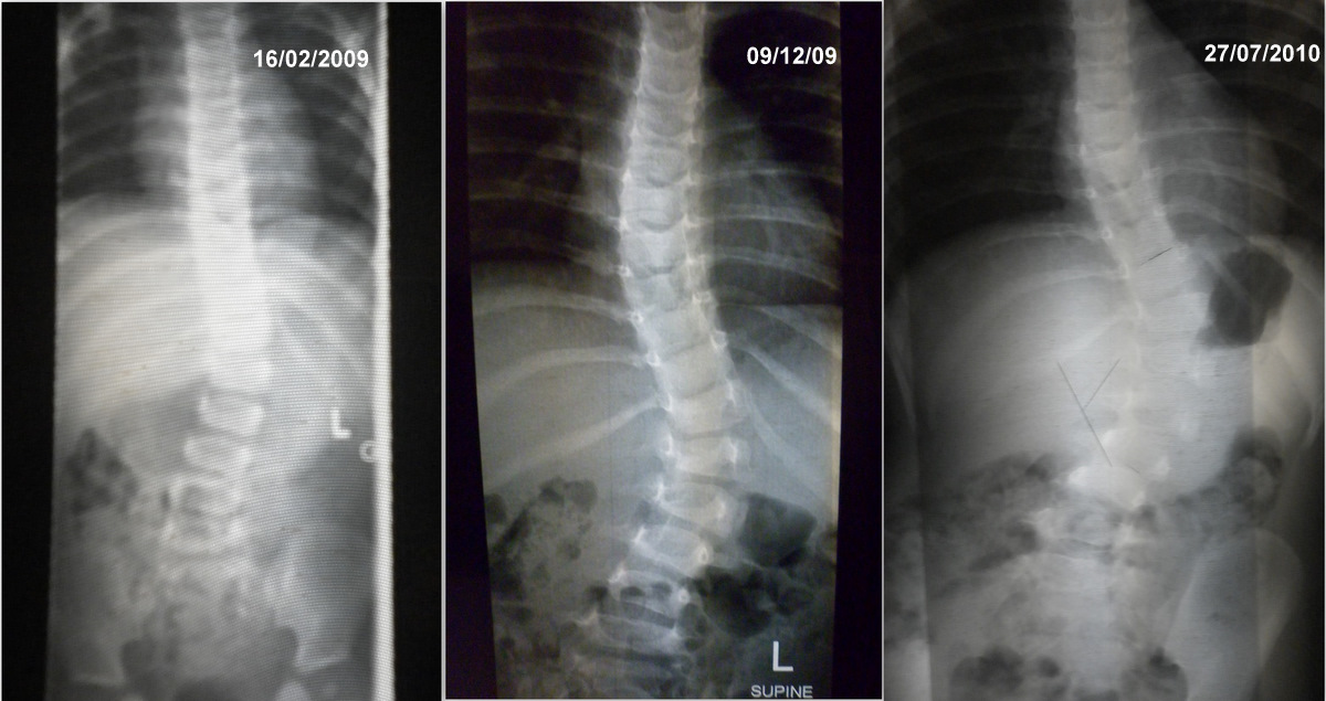 Life with Beals: Scoliosis