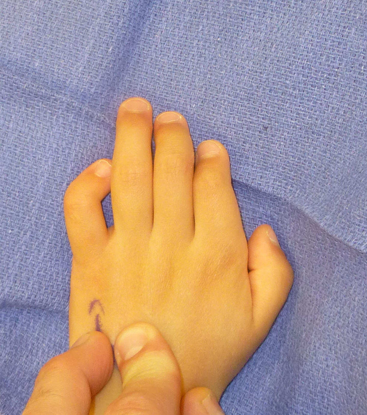 Clinodactyly Minimally Invasive Treatment | Congenital Hand and Arm ...