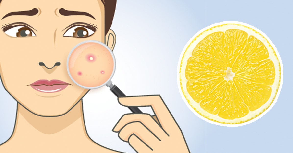 How To Remove Scars And Acne Marks Just With Lemon