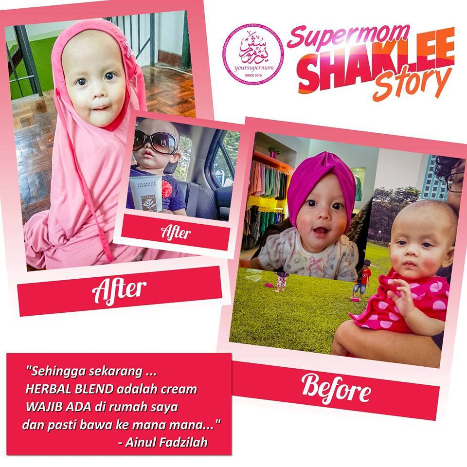 Cara Hilangkan Ruam Susu Di Muka Bayi | VITAMIN UMMI ZARA - PAKAR ...