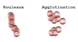 Autoimmune Hemolytic Anemias (AIHA)