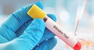 total Bilirubin